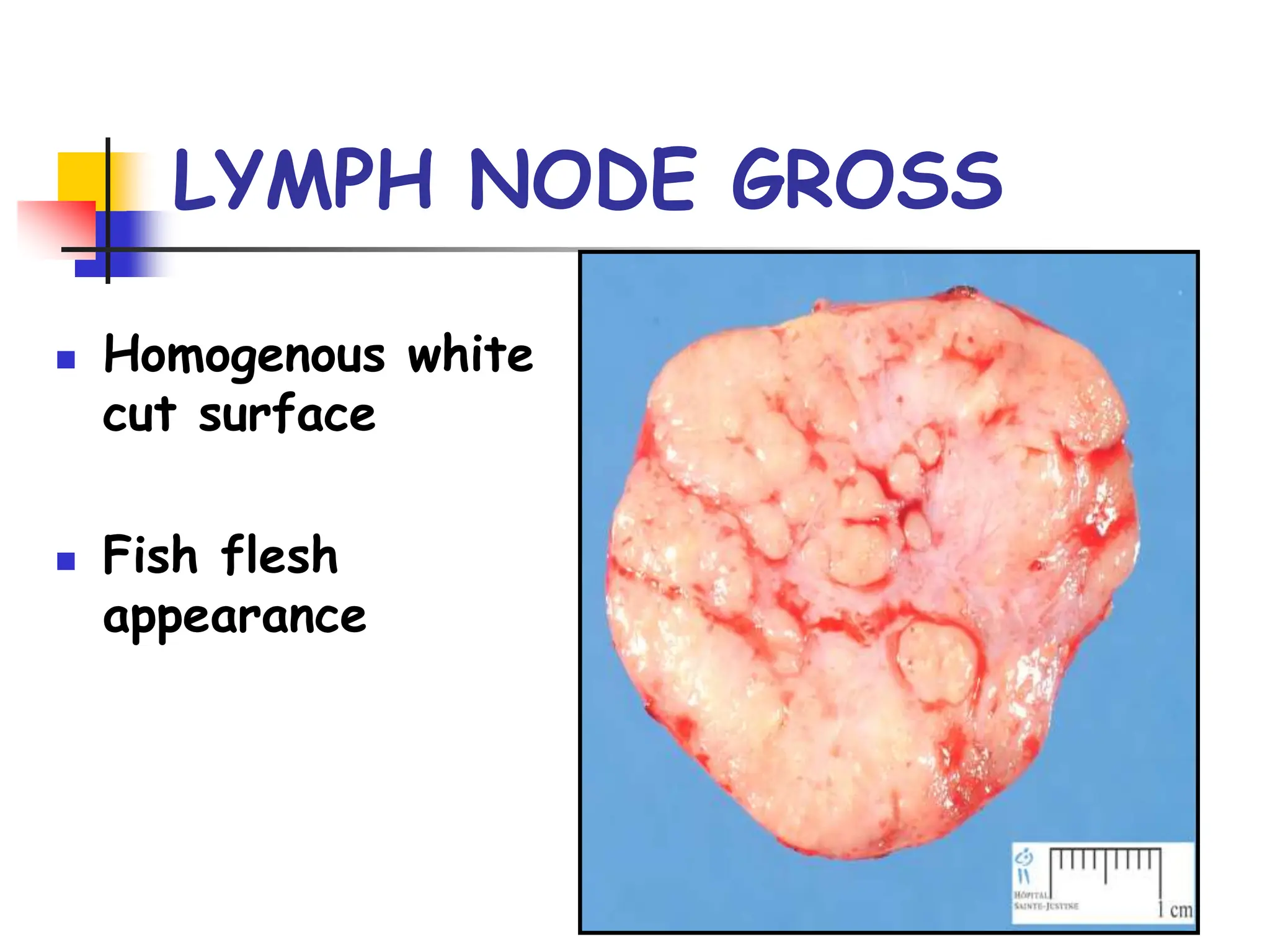 HODGKIN LYMPHOMA - DEFINITION, PATHOGENESIS & PATHOLOGY | PPT