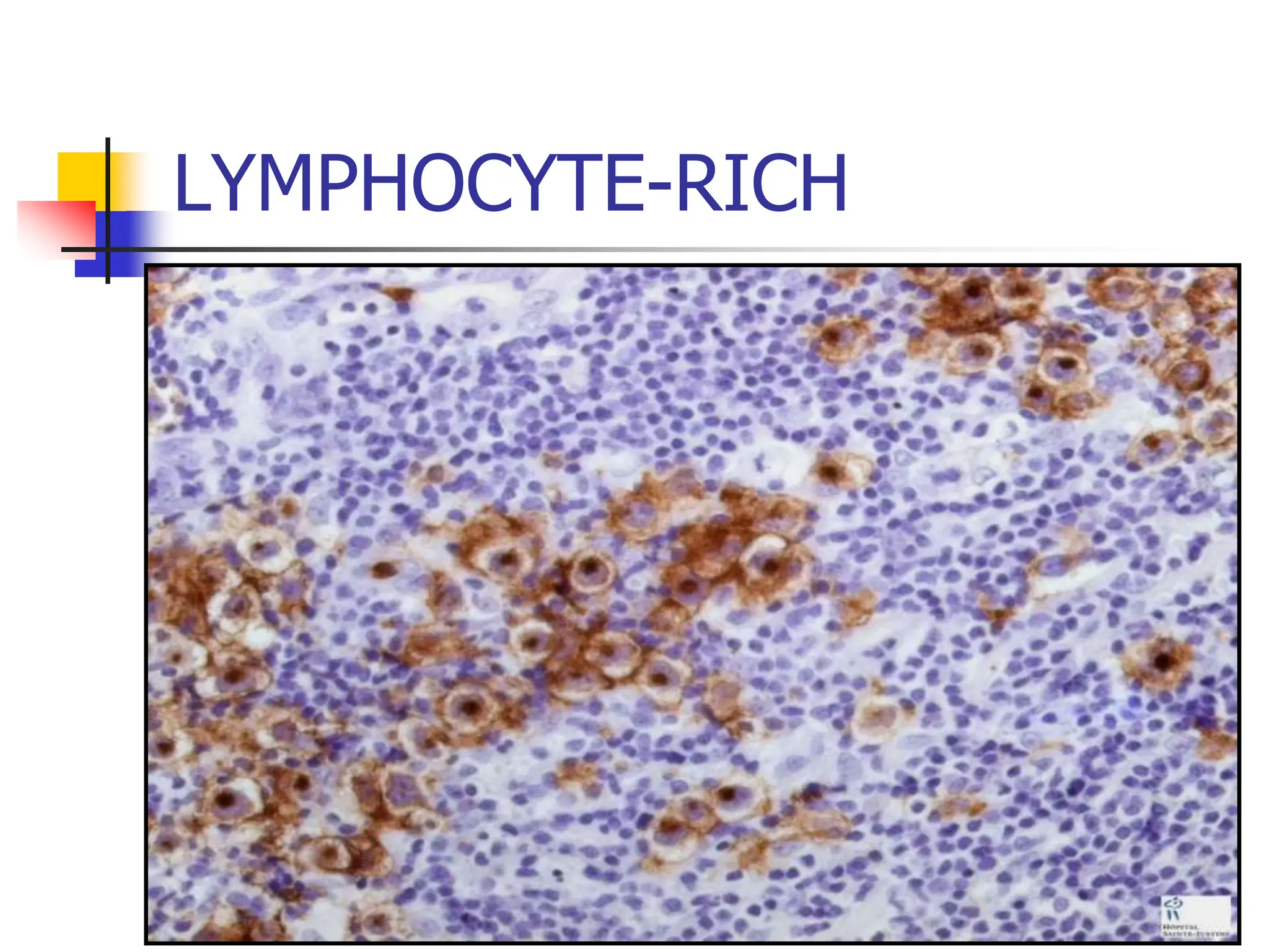 HODGKIN LYMPHOMA - DEFINITION, PATHOGENESIS & PATHOLOGY | PPT