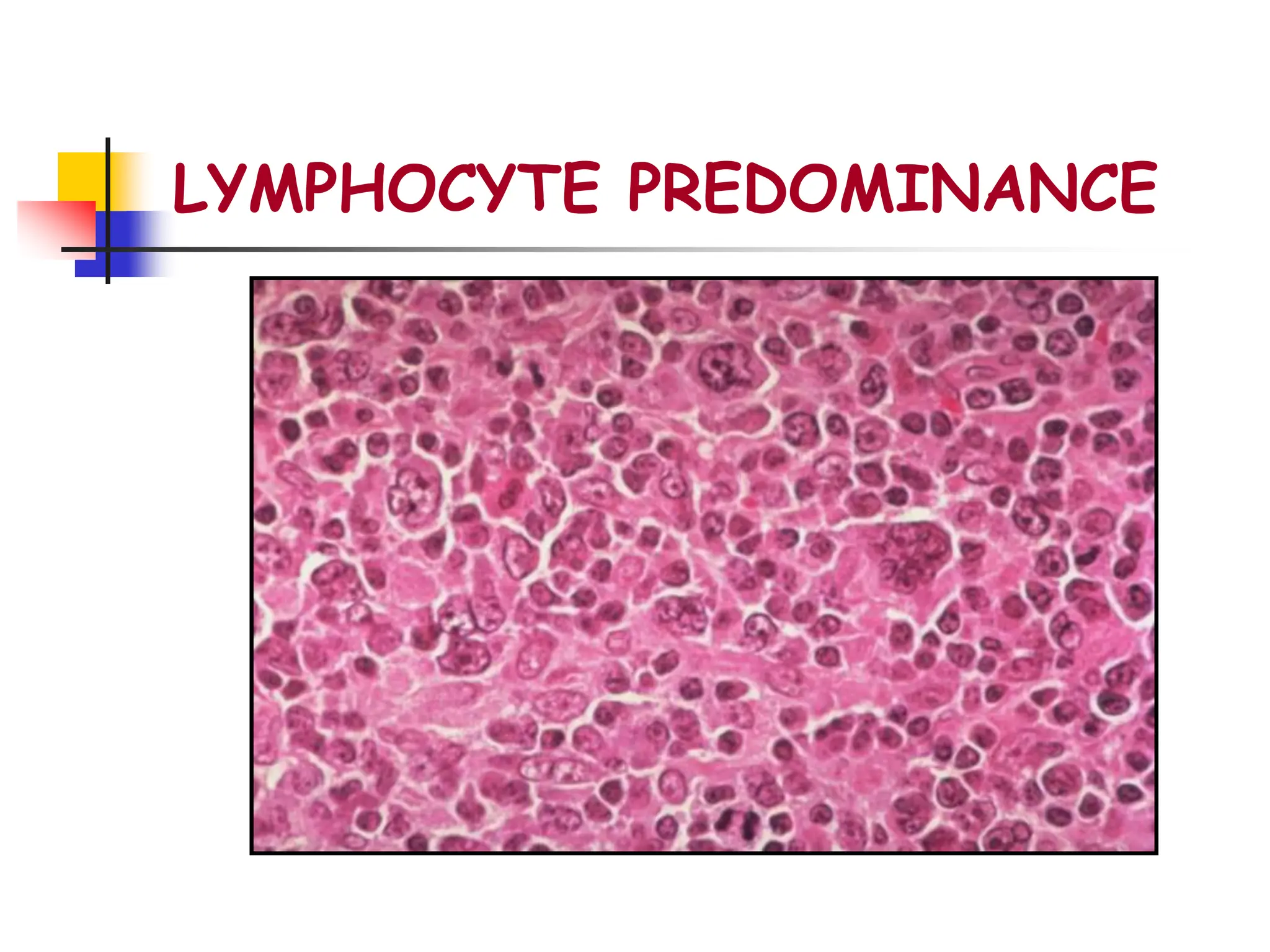 HODGKIN LYMPHOMA - DEFINITION, PATHOGENESIS & PATHOLOGY | PPT