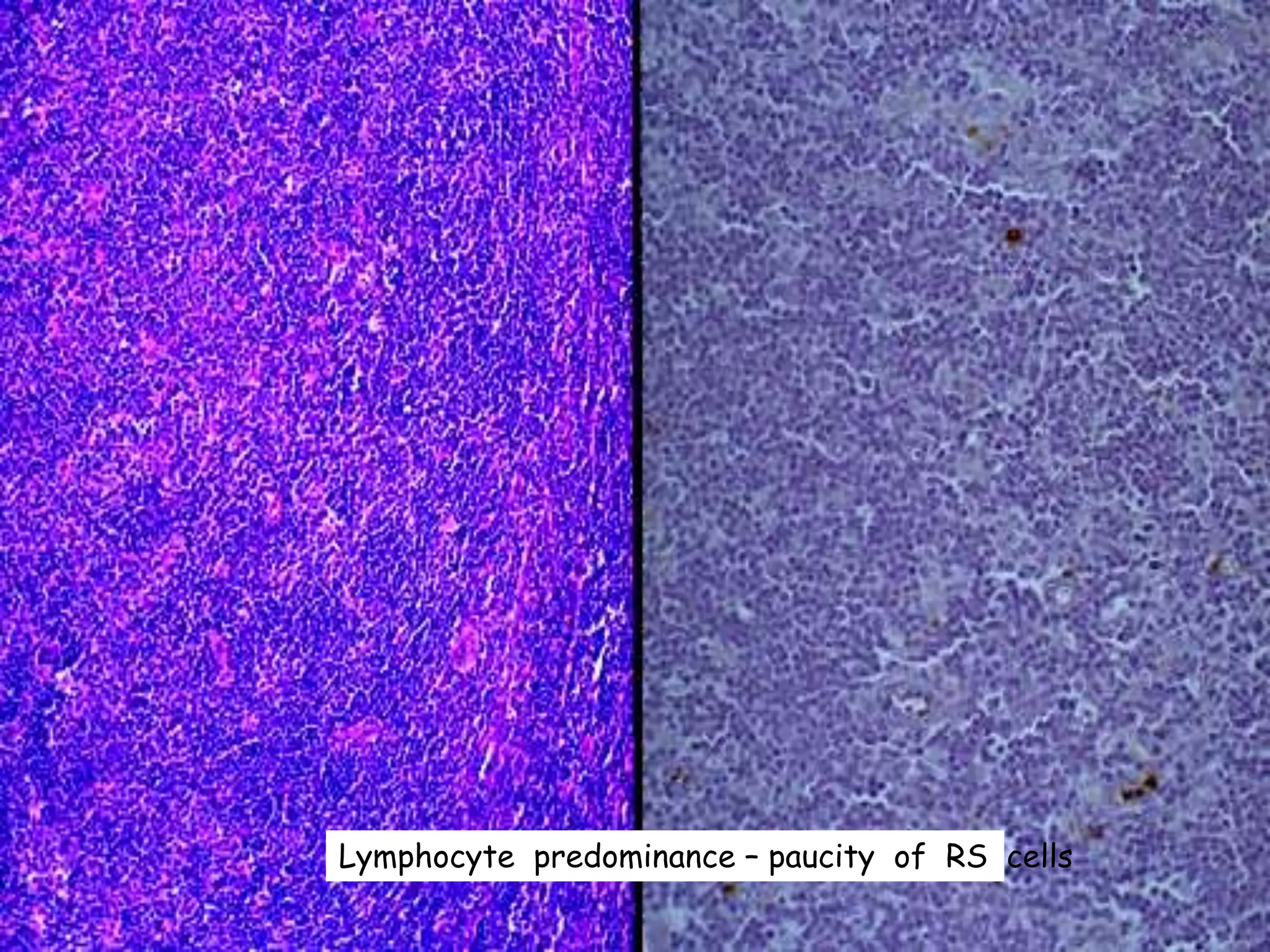 HODGKIN LYMPHOMA - DEFINITION, PATHOGENESIS & PATHOLOGY | PPT