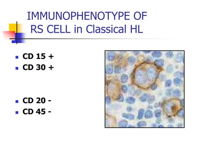 HODGKIN LYMPHOMA - DEFINITION, PATHOGENESIS & PATHOLOGY | PPT | Blood Disorders | Diseases and ...