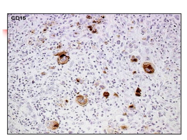 HODGKIN LYMPHOMA - DEFINITION, PATHOGENESIS & PATHOLOGY | PPT | Blood ...