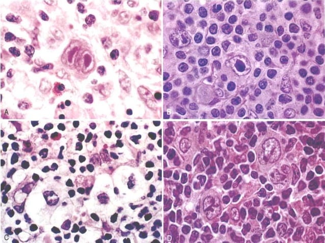 HODGKIN LYMPHOMA - DEFINITION, PATHOGENESIS & PATHOLOGY | PPT | Blood Disorders | Diseases and ...