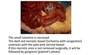 GANGRENE | PDF
