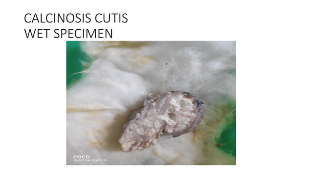 PATHOLOGICAL CALCIFICATION | PDF | Skin and Dermatology | Diseases and ...