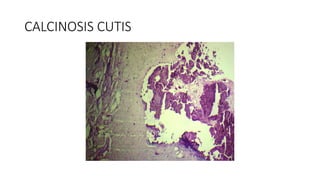 PATHOLOGICAL CALCIFICATION | PDF