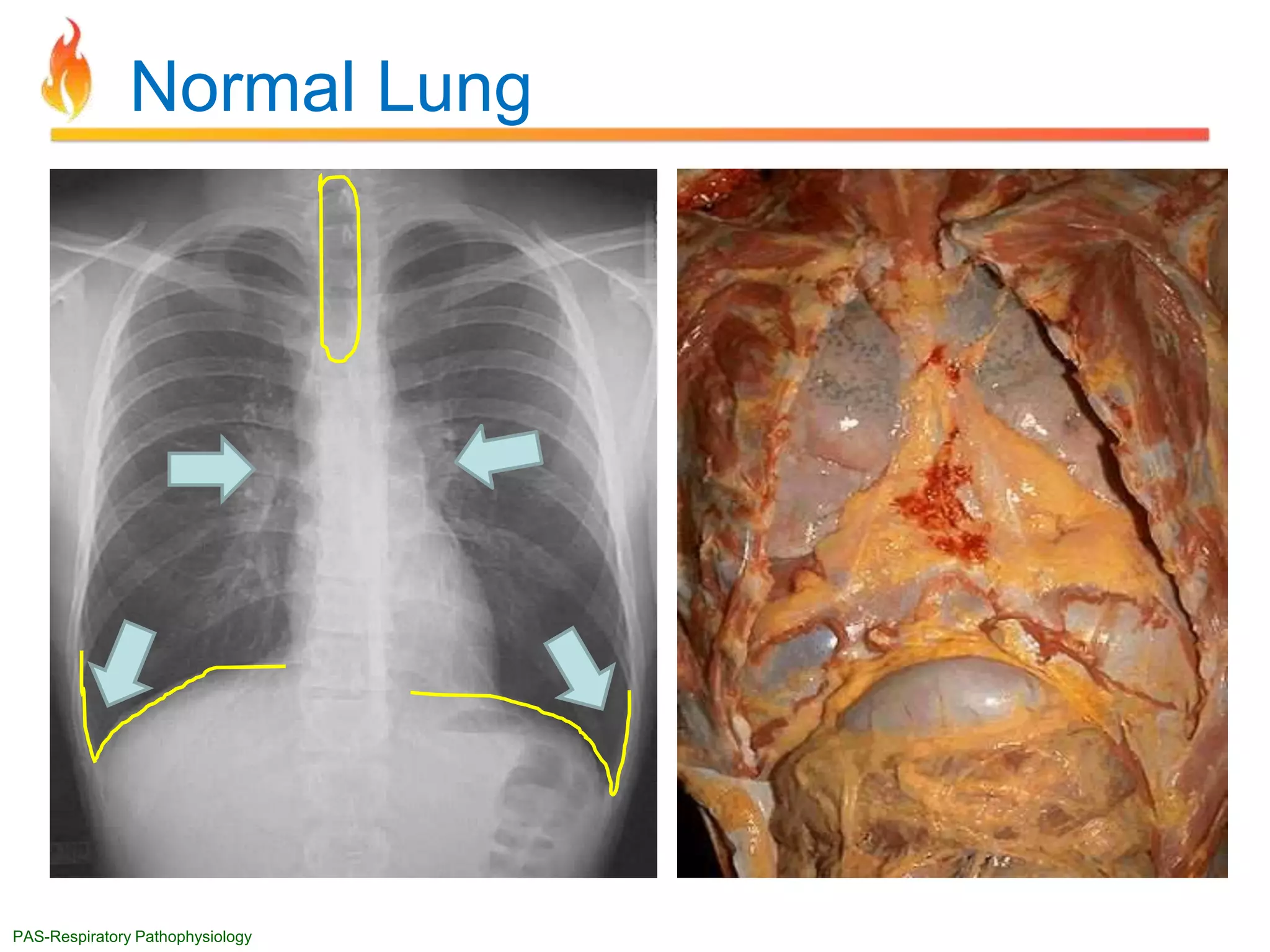 Pathology of Respiratory System Disorders | PPTX