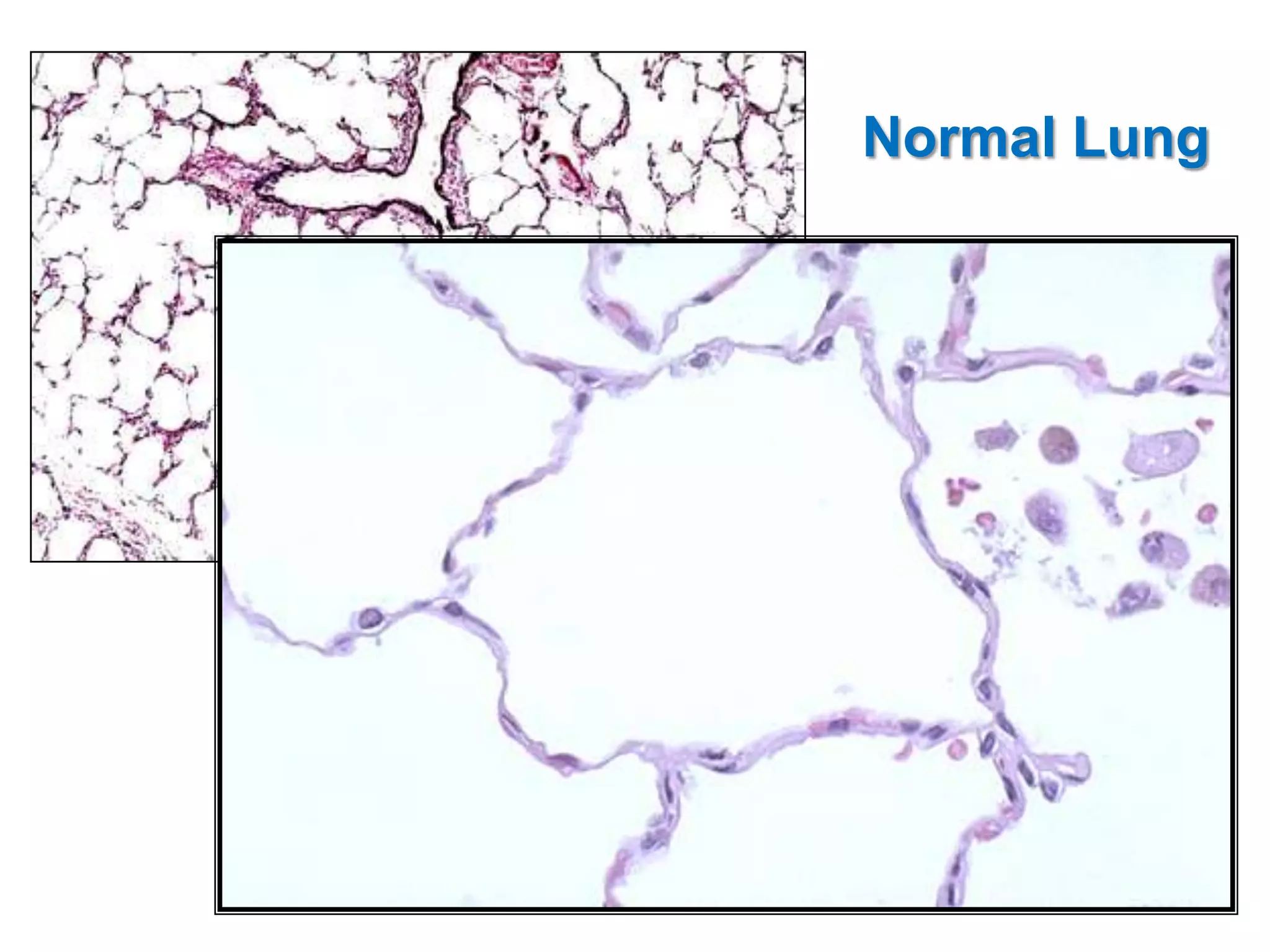 Pathology of Respiratory System Disorders | PPTX
