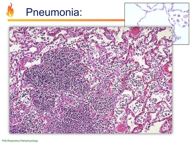Pathology of Respiratory System Disorders