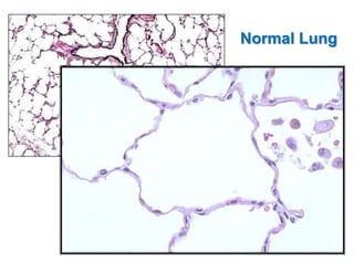 Normal Lung Slide