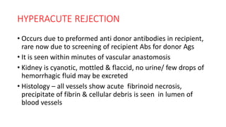 TRANSPLANT REJECTION - TYPES & MECHANISM | PDF