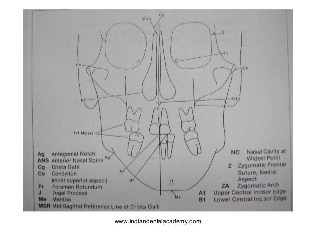 Postero anterior cephalometric analysis/certified fixed orthodontic c…