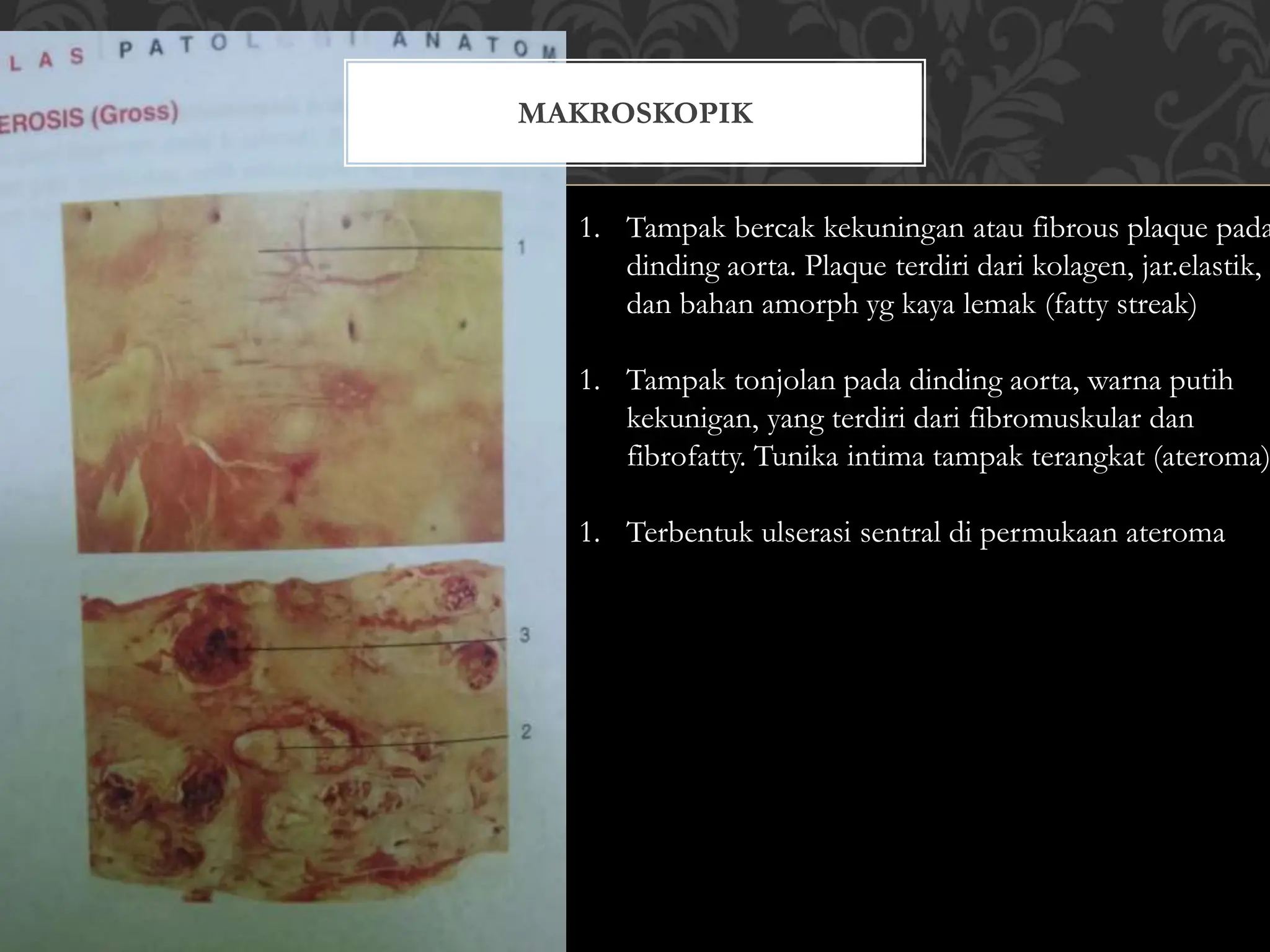 PA Aterosklerosis IDK for fakultas kedokteran | PPT