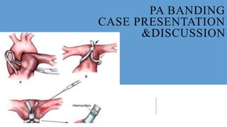 Pulmonary Artery Banding-Why? when? How? | PPTX