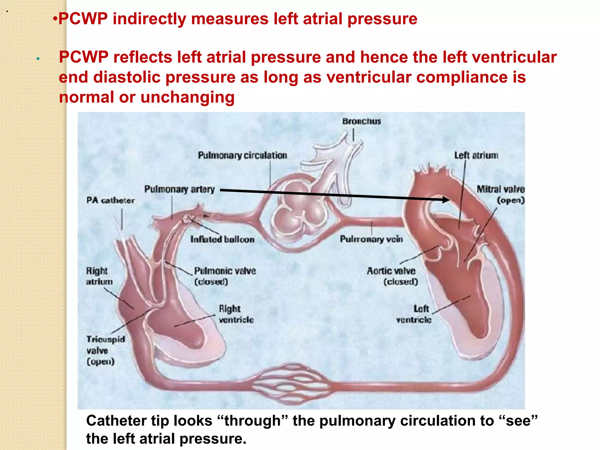Pa catheter ctvac | PPTX