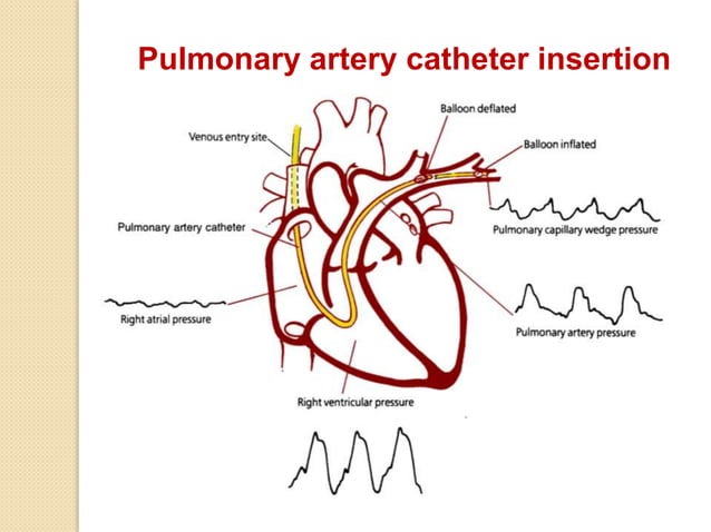 Pa catheter ctvac | PPTX | Heart and Cardiovascular Diseases | Diseases and Conditions