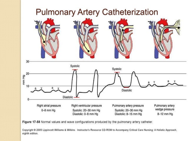 Pa catheter ctvac | PPTX | Heart and Cardiovascular Diseases | Diseases ...