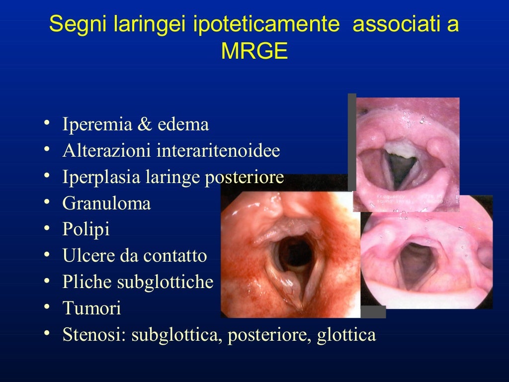 Pace F. La Malattia da Reflusso Gastroesofageo: questa sconosciuta. A…