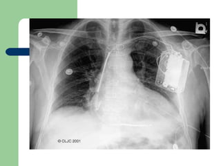 Pacemaker and anaesthesia | PPT