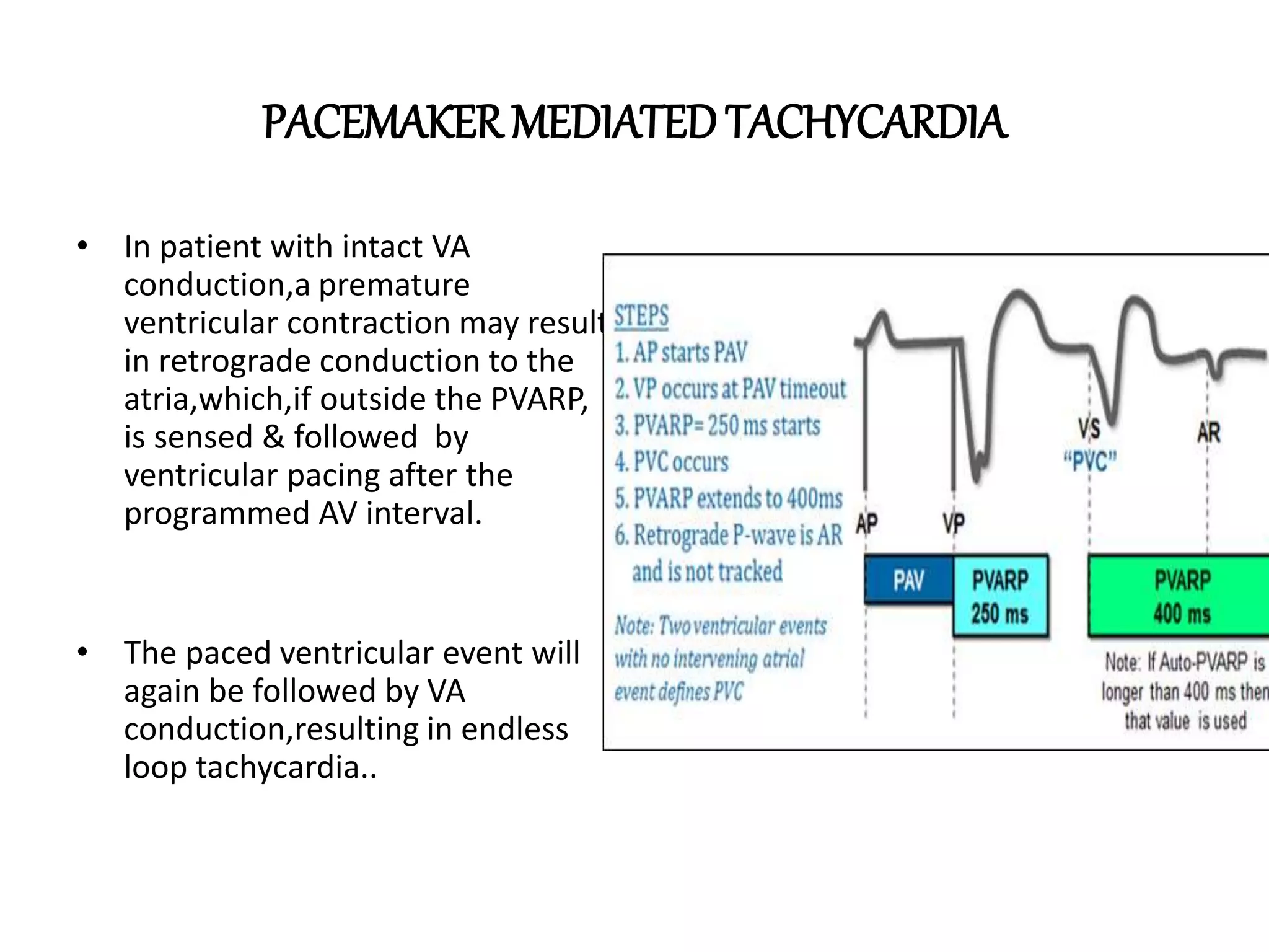Pacemaker | PPT