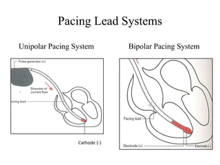 Artificial Cardiac Pacemaker | PPTX