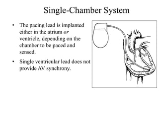 Artificial Cardiac Pacemaker | PPTX