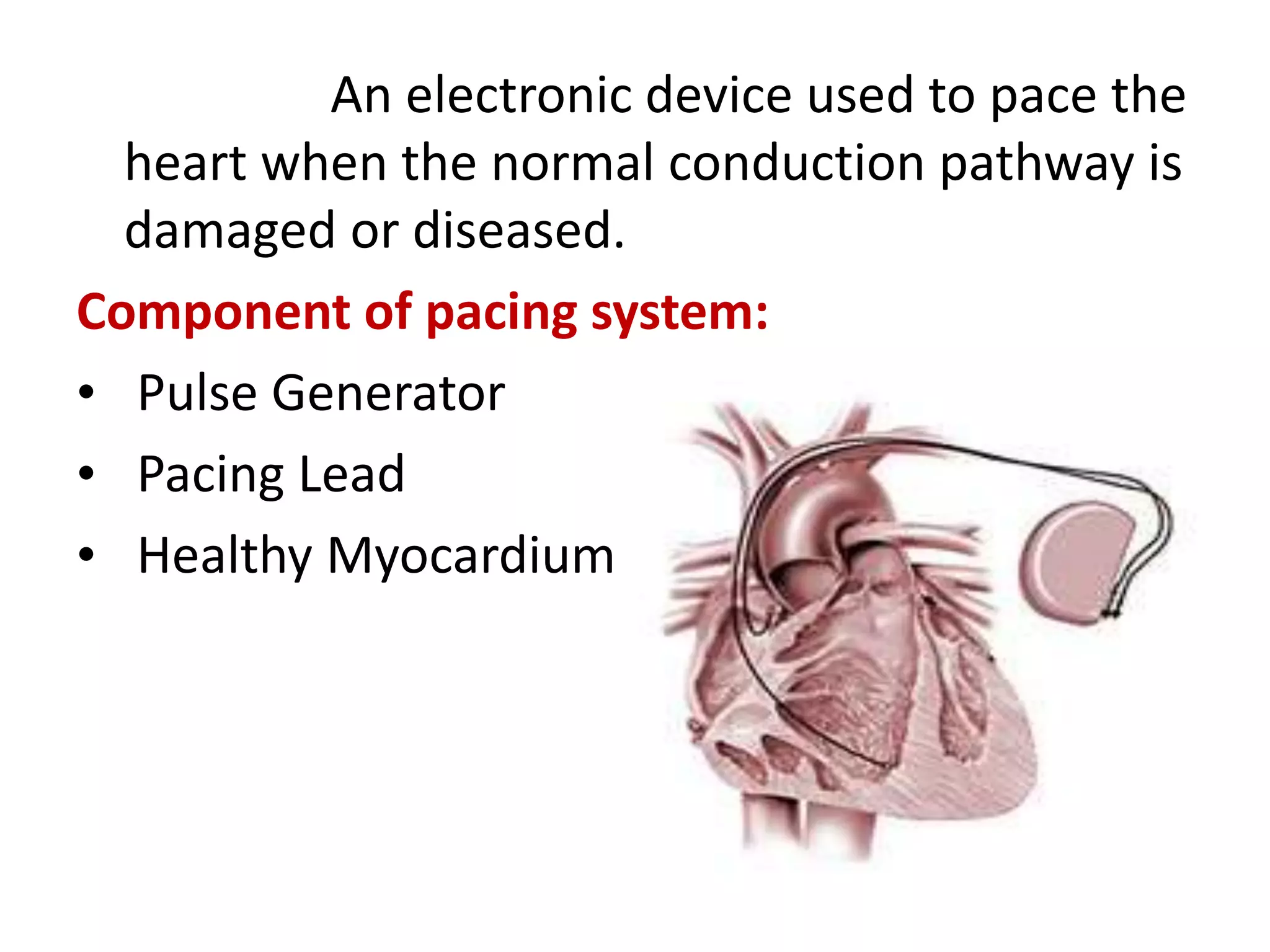 Pacemaker | PPSX