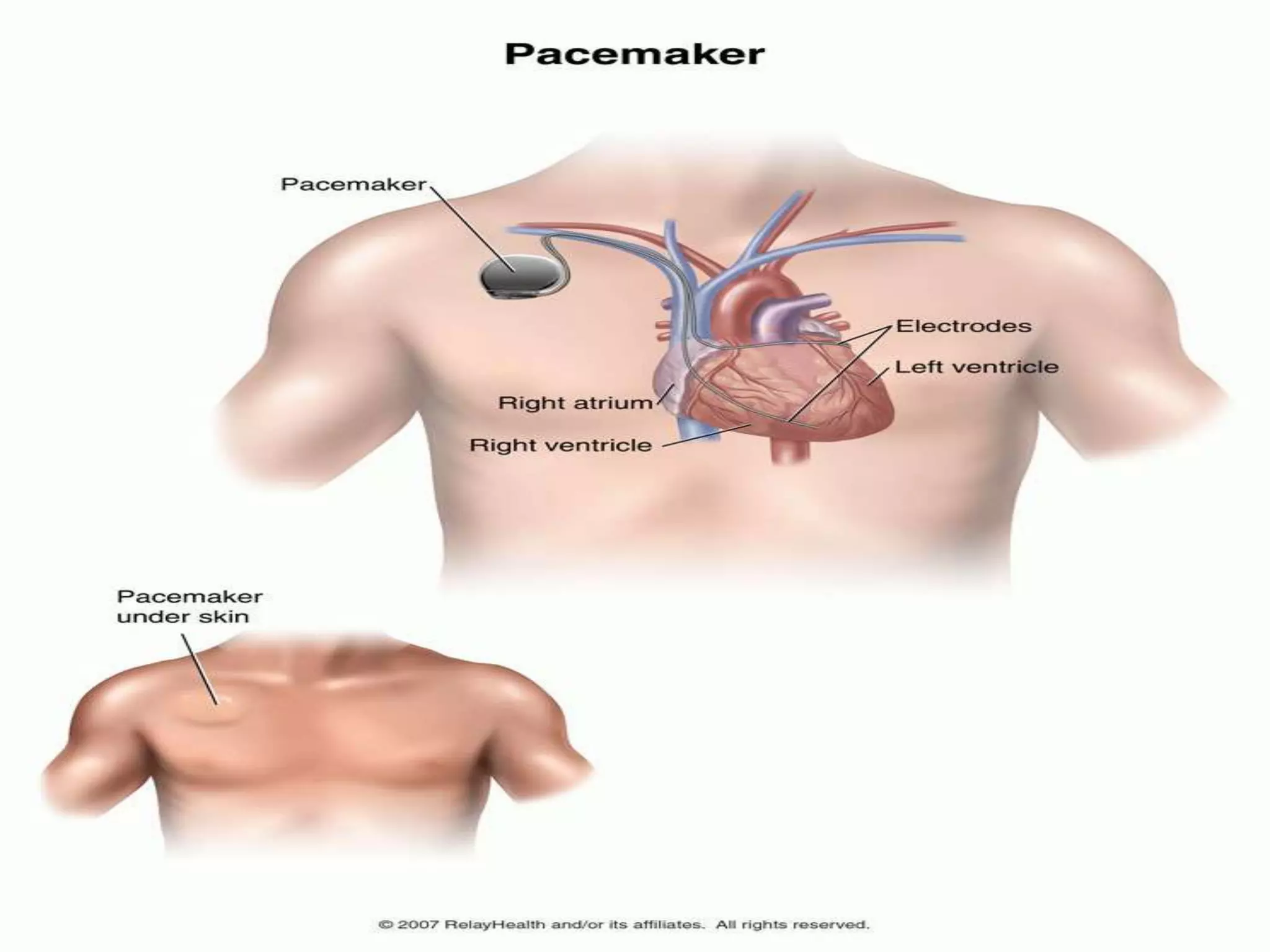 Pacemaker | PPTX