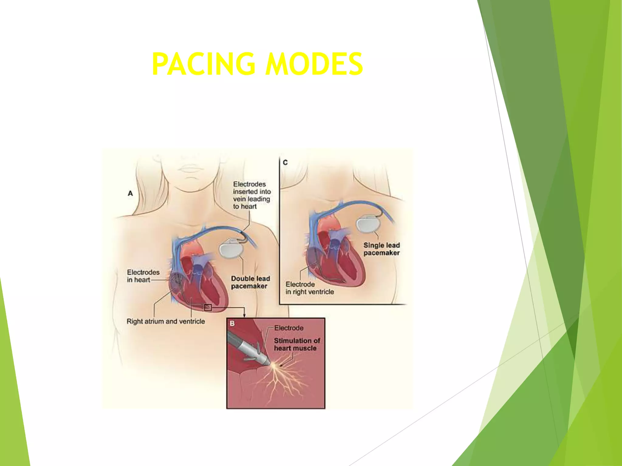 Pacemaker | PPTX