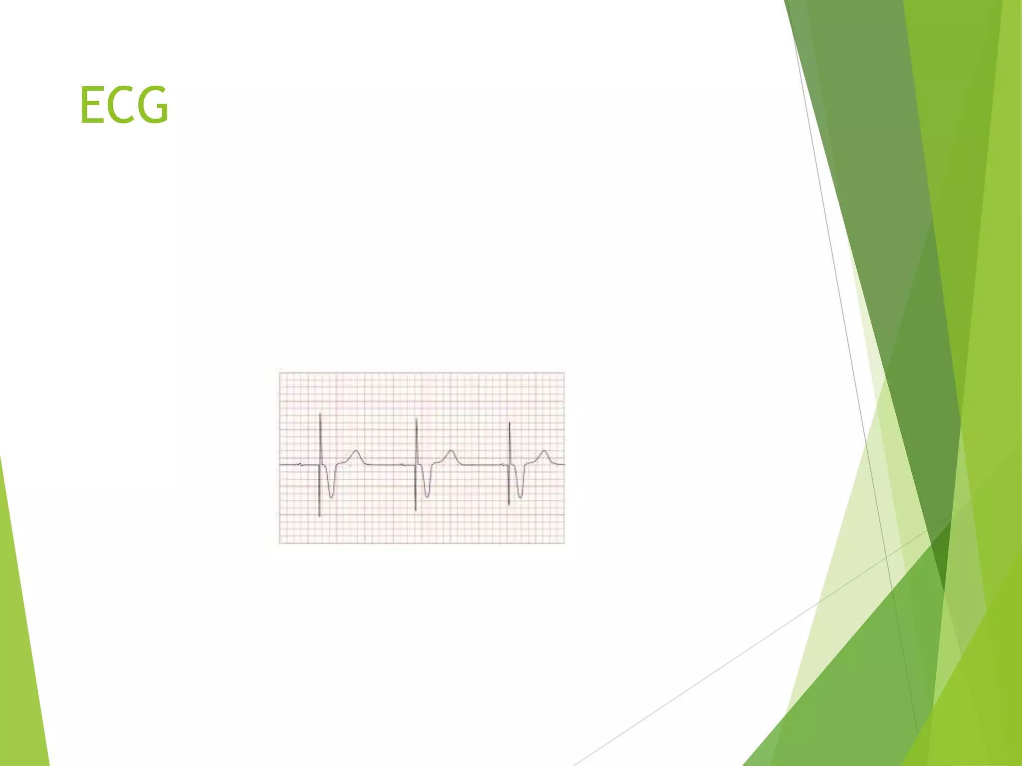Pacemaker | PPTX