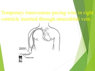 Pacemaker | PPTX