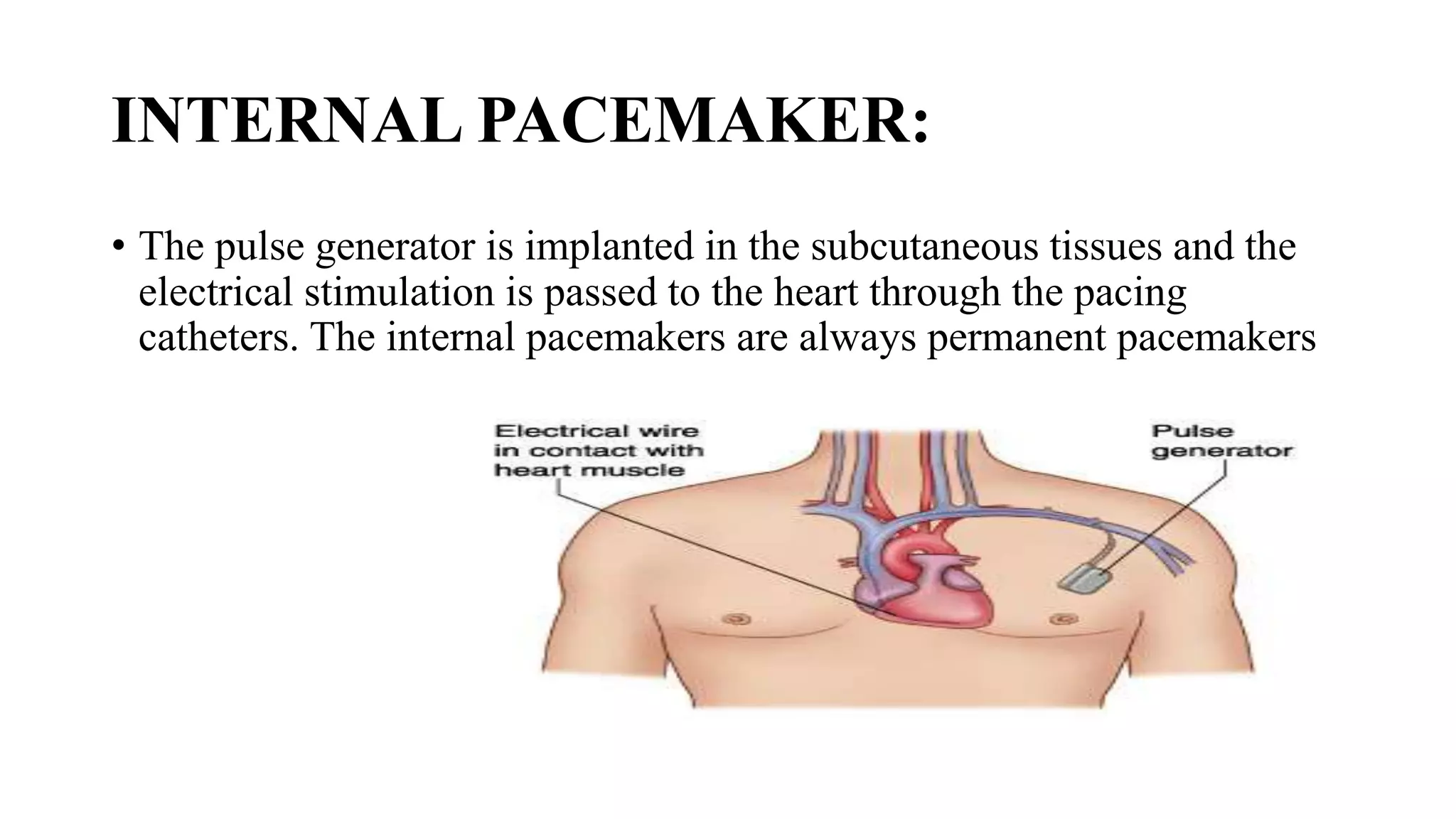 Pacemaker | PPTX
