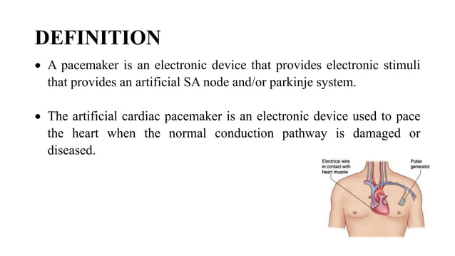 Pacemaker | PPTX