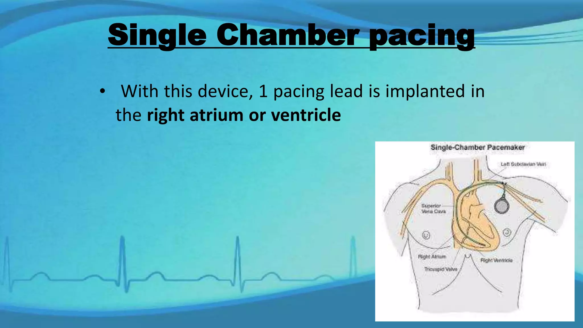 Pacemaker | PPTX | Heart and Cardiovascular Diseases | Diseases and ...