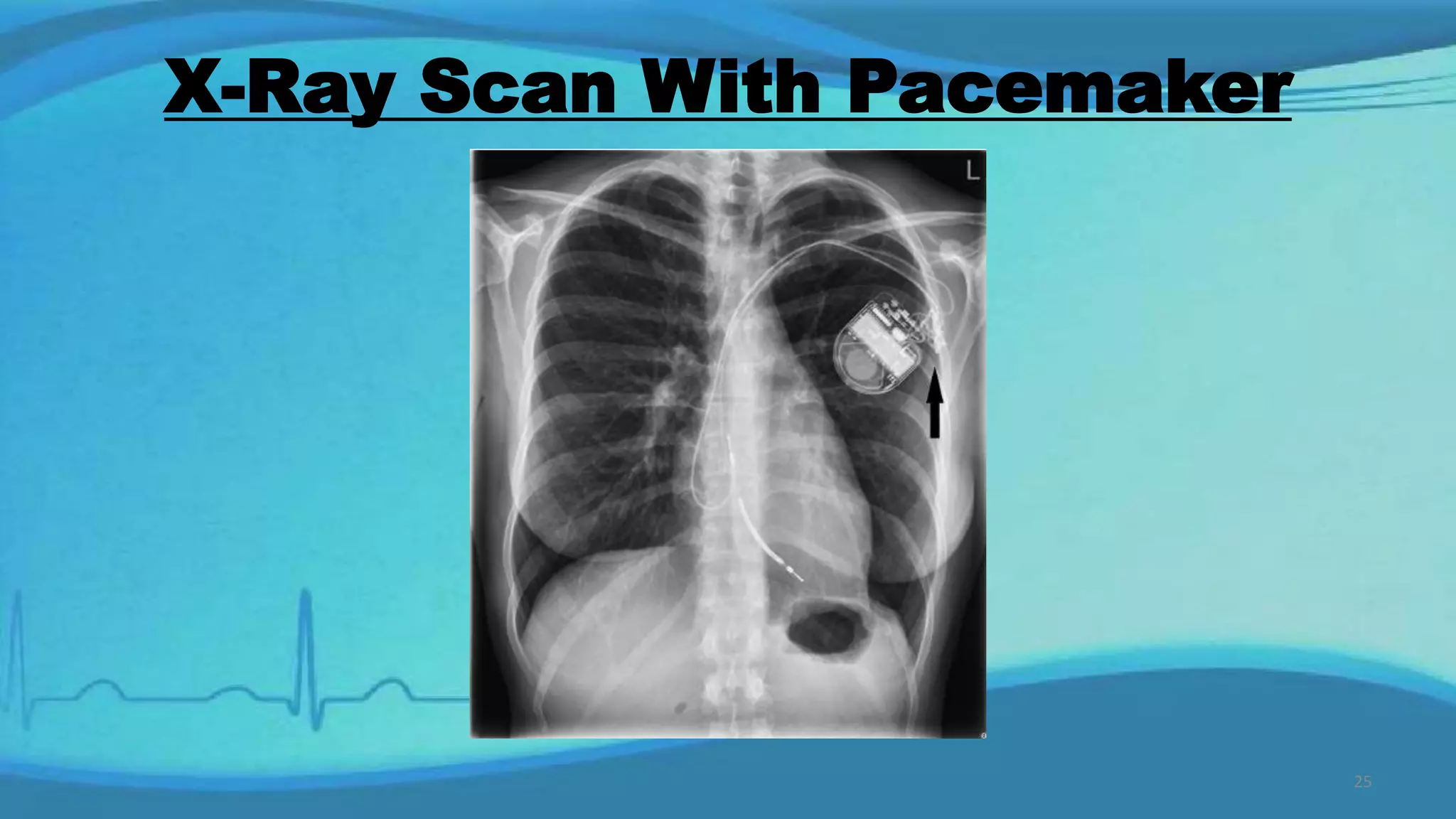 Pacemaker | PPTX | Heart and Cardiovascular Diseases | Diseases and ...