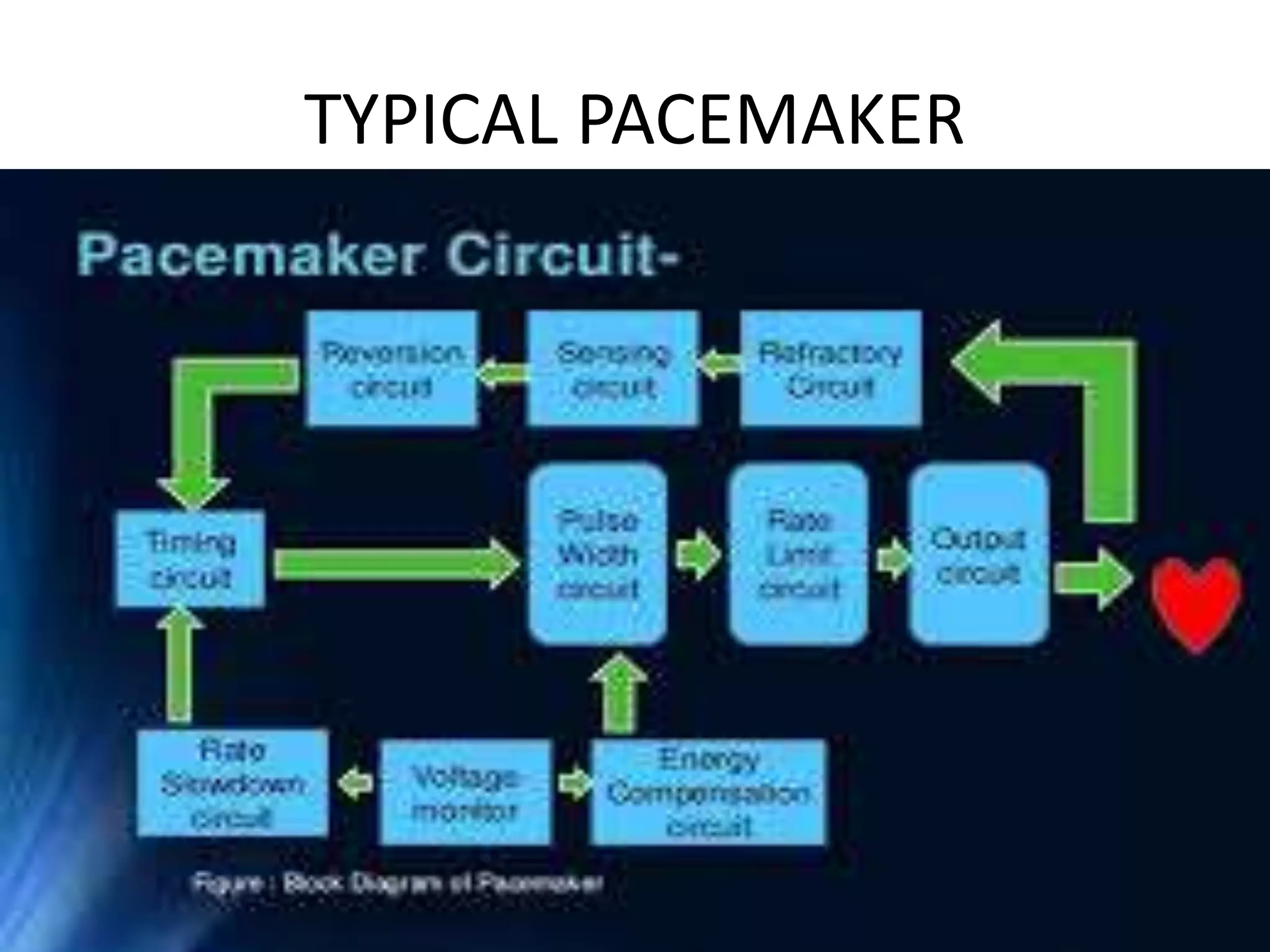 Pacemaker | PPT