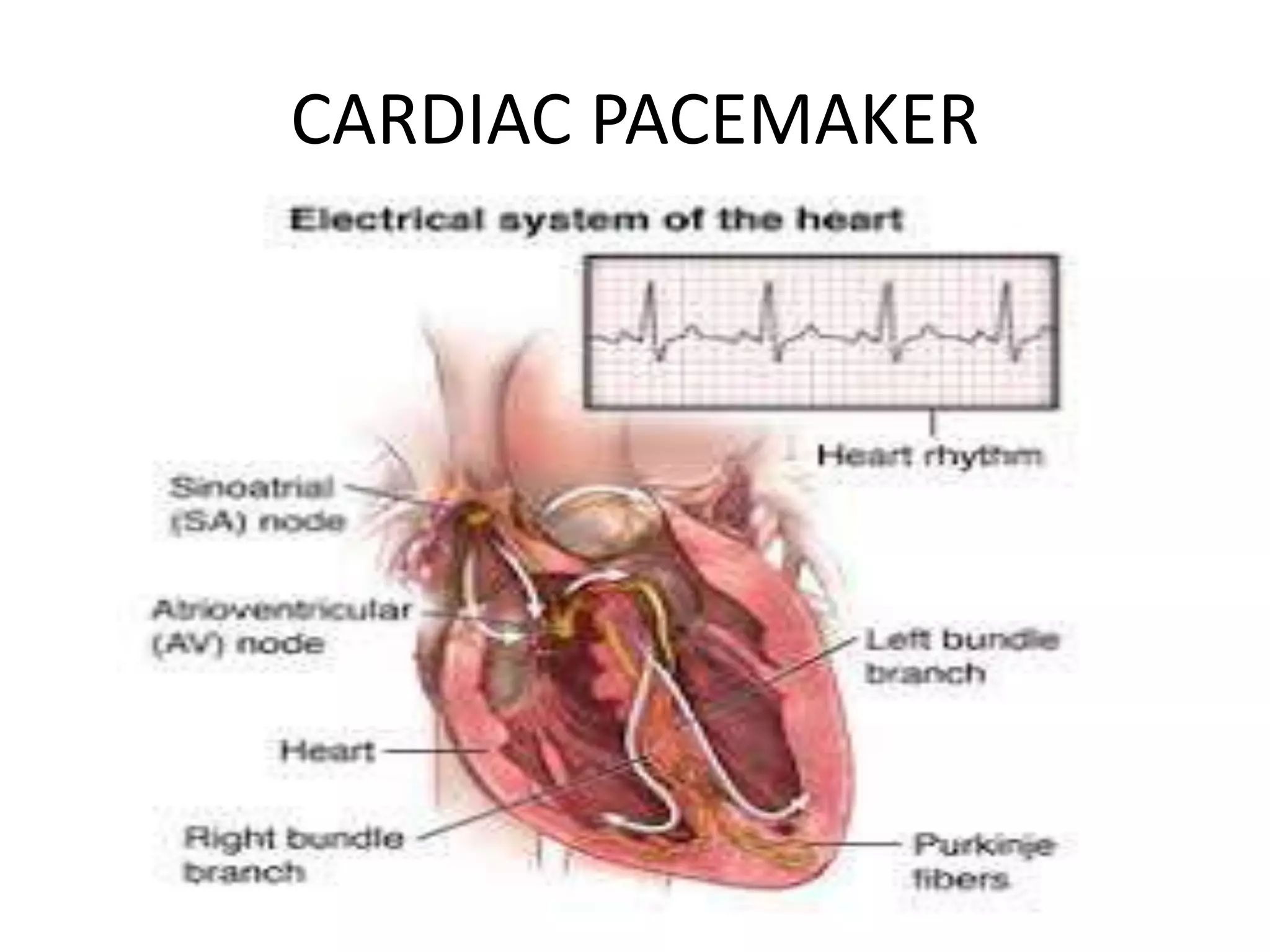 Pacemaker | PPT
