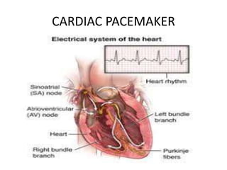 Pacemaker | PPT