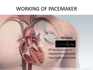 Pacemaker | PPT
