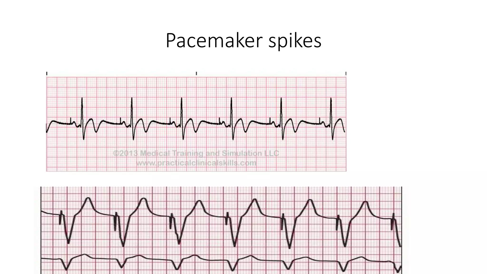 Pacemaker | PPTX