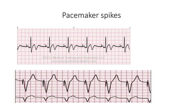 Pacemaker | PPTX