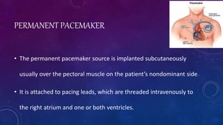 Pacemaker | PPTX