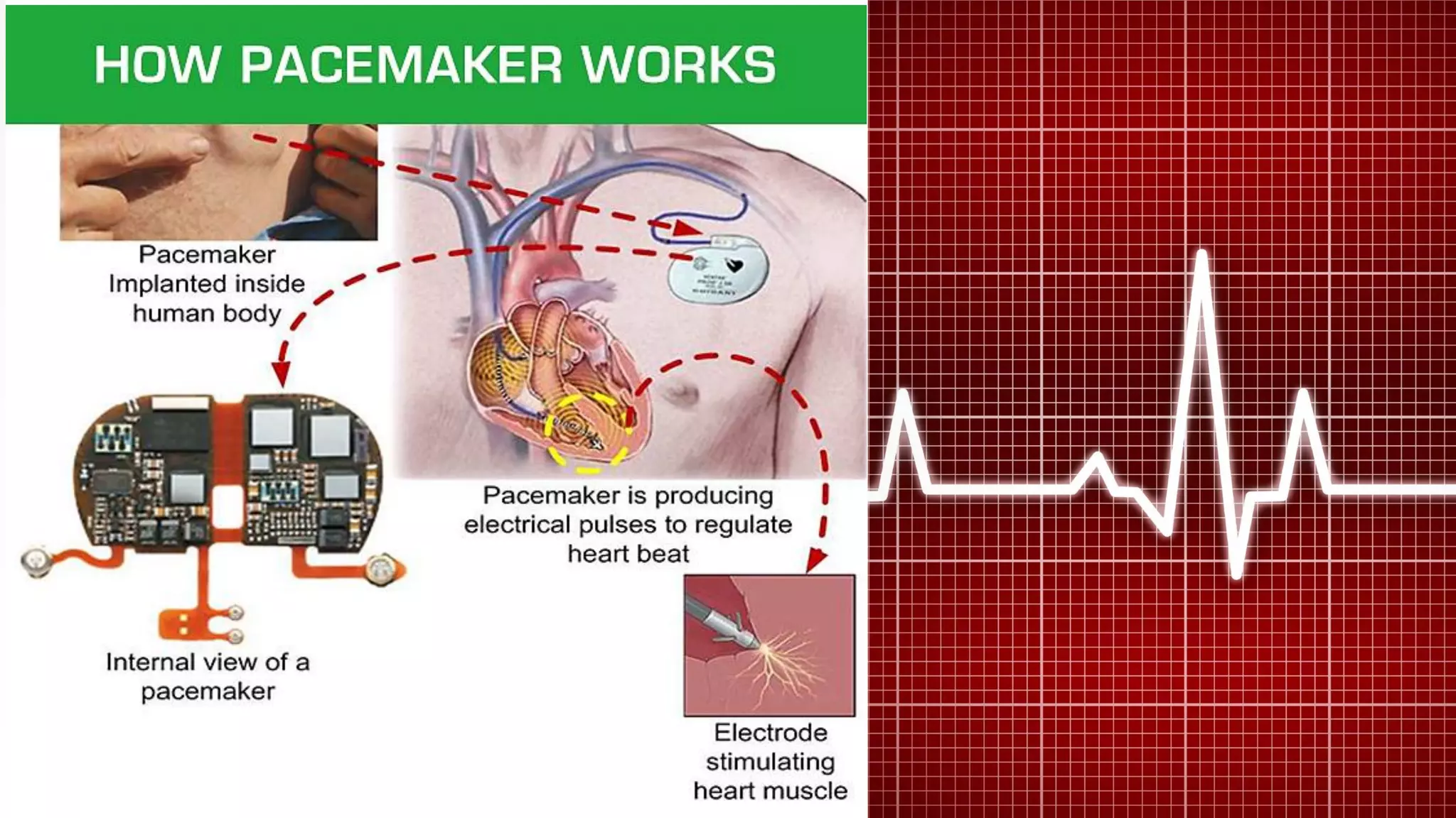 PACEMAKER | PDF