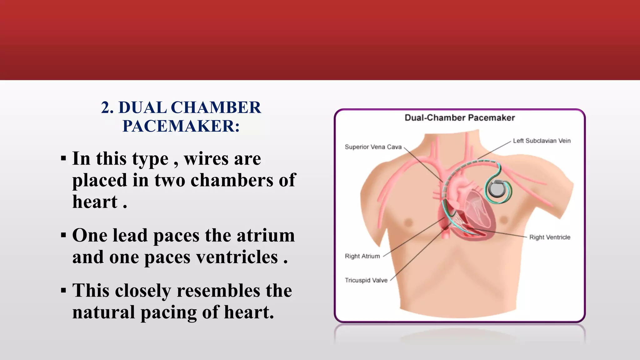 PACEMAKER | PDF
