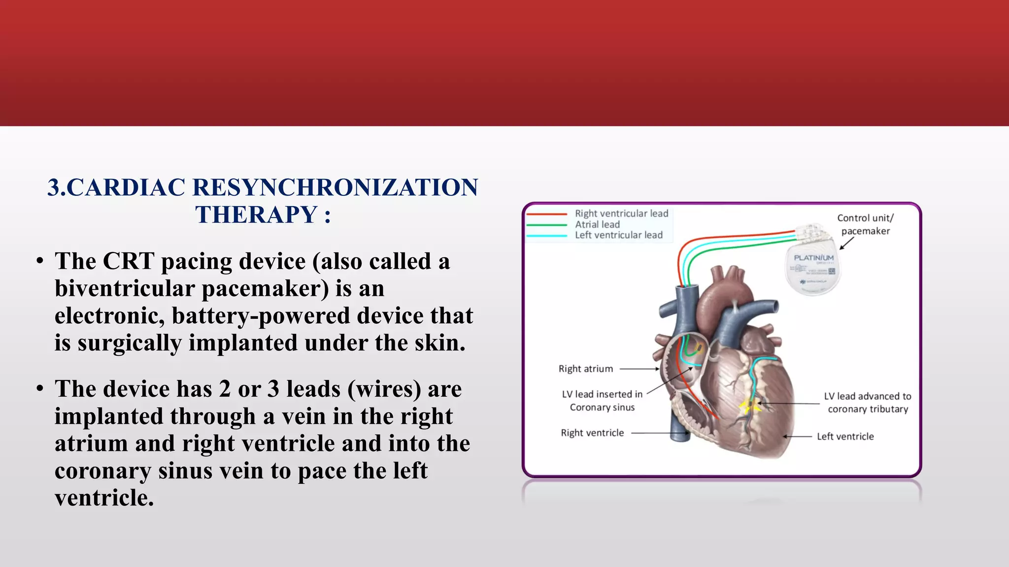 PACEMAKER | PDF