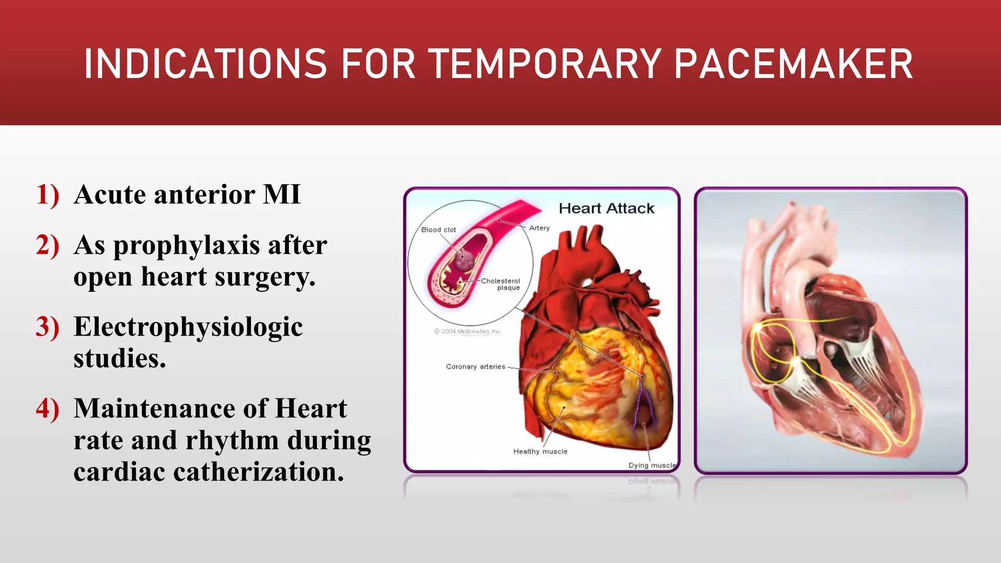 PACEMAKER | PDF