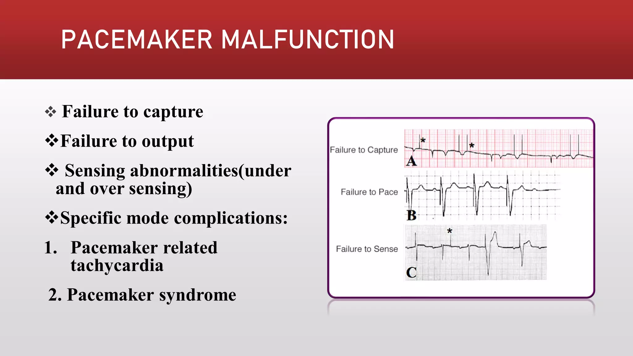 PACEMAKER | PDF