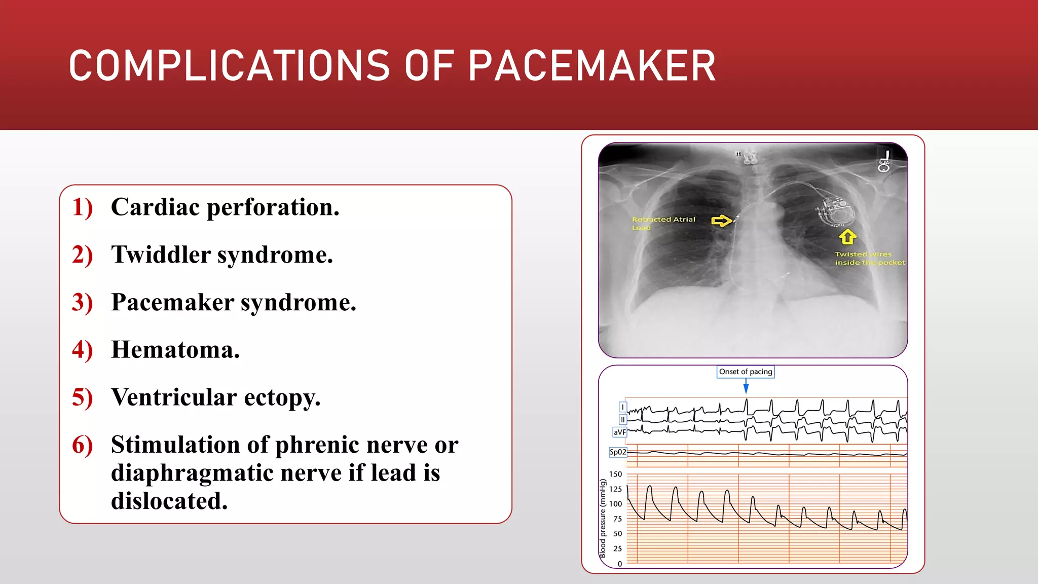 PACEMAKER | PDF