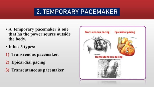 PACEMAKER | PDF | Heart and Cardiovascular Diseases | Diseases and ...