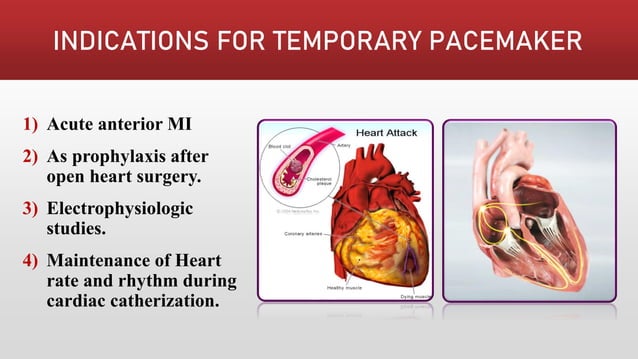 PACEMAKER | PDF | Heart and Cardiovascular Diseases | Diseases and ...